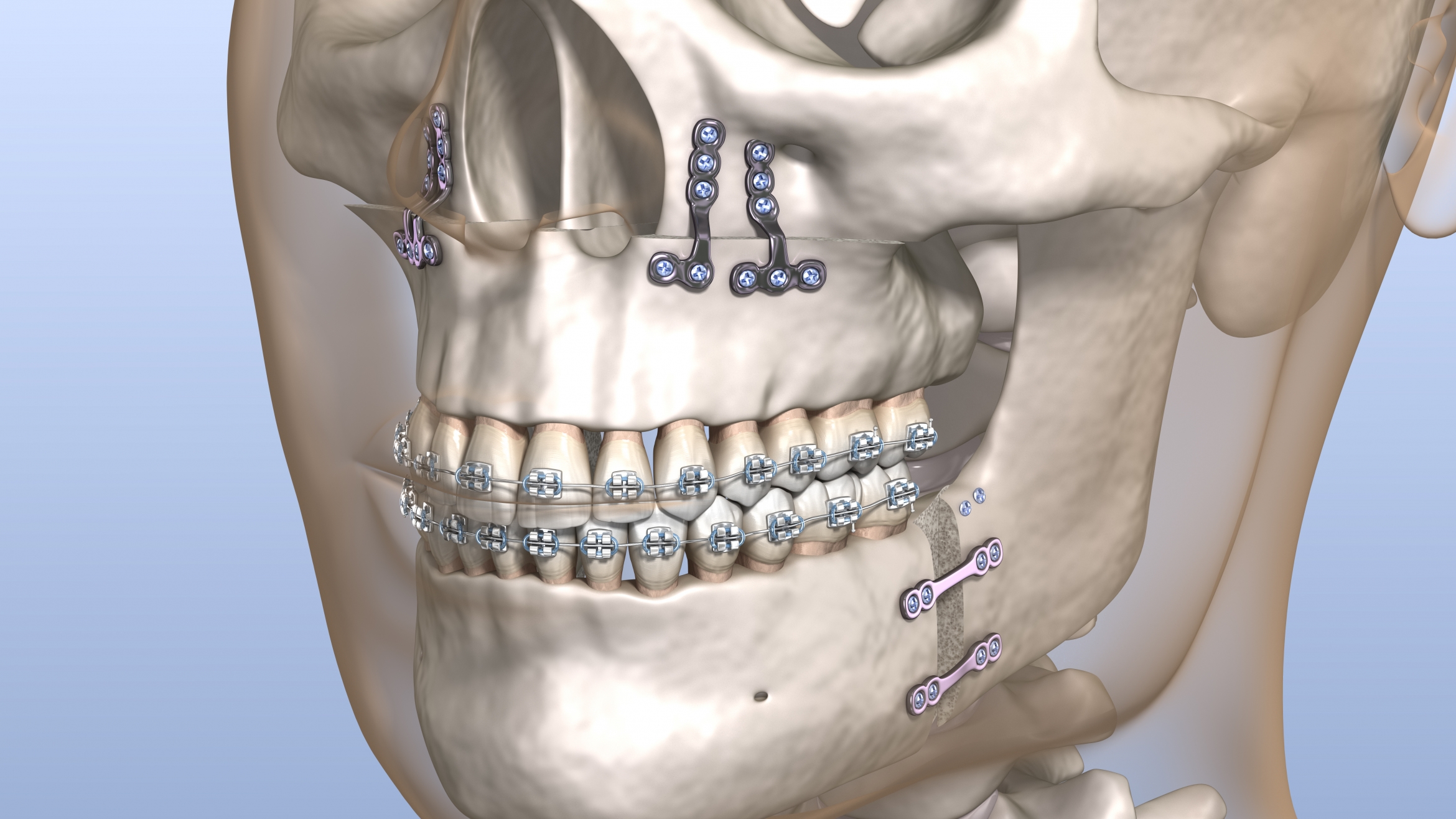 Orthognathic Surgery Montville Oral Surgery Orthognathic Surgery Montville Oral Surgery
